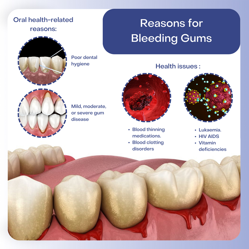 Bleeding Gums Treatment East Bronx NY