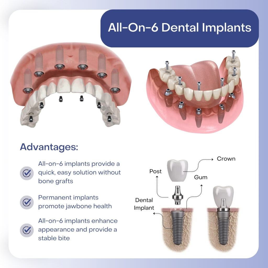 All-On-6 Dental Implants